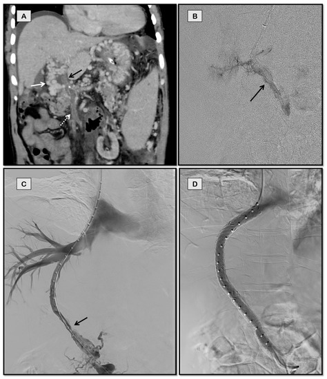 Diagnostics | Free Full-Text | Transjugular Intrahepatic Portosystemic ...