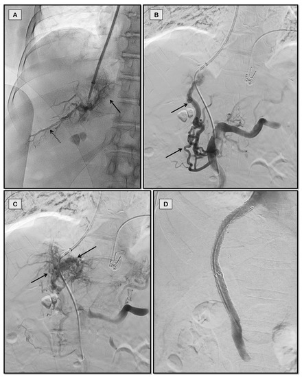 Diagnostics | Free Full-Text | Transjugular Intrahepatic Portosystemic ...
