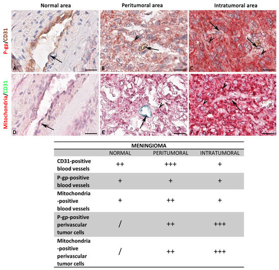 Differential P-Glycoprotein/CD31 Expression as Markers of Vascular Co ...