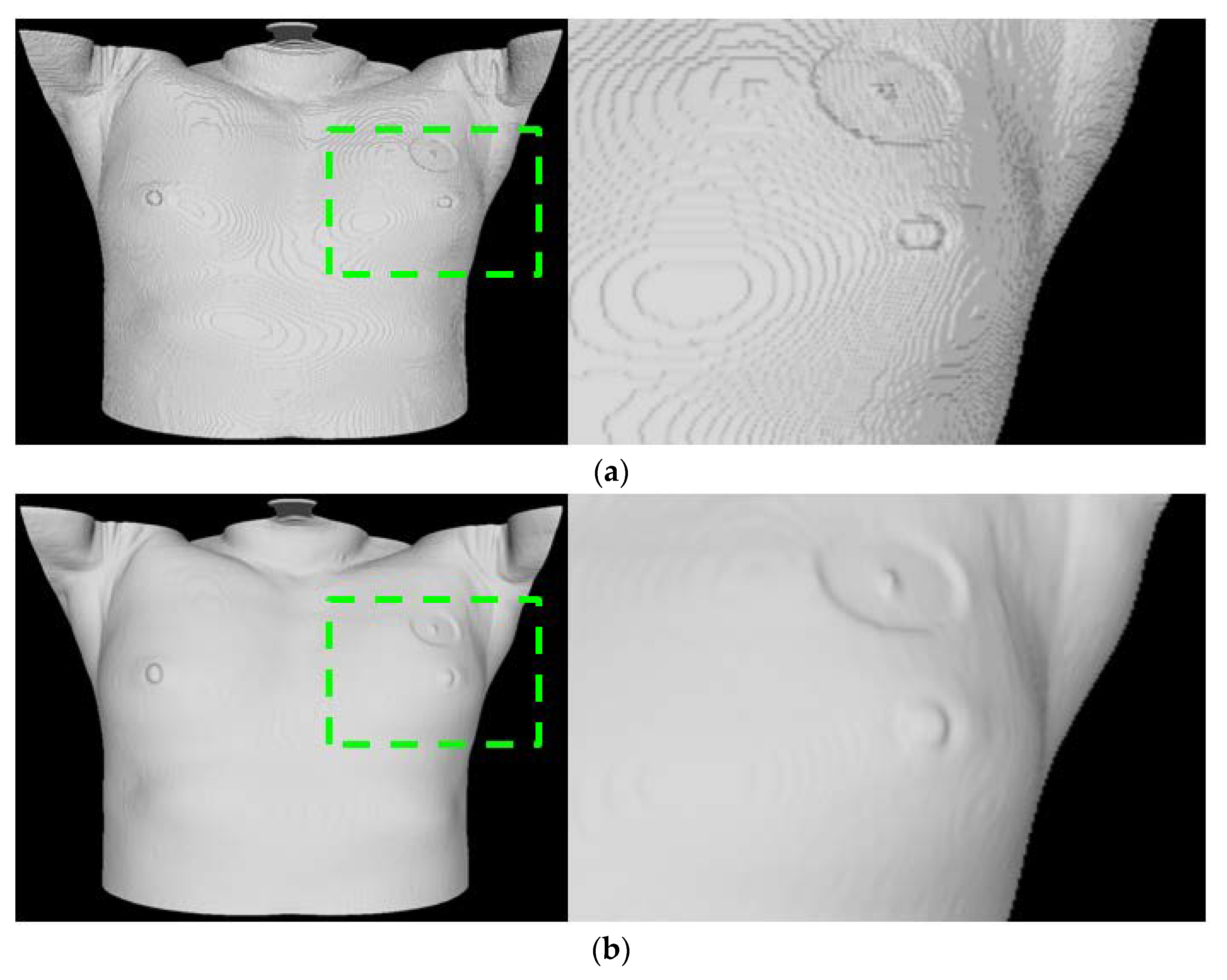 Computer-Aided Breast Surgery Framework Using a Markerless Augmented ...