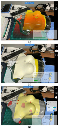 Diagnostics | Free Full-Text | Computer-Aided Breast Surgery Framework Using a Markerless ...