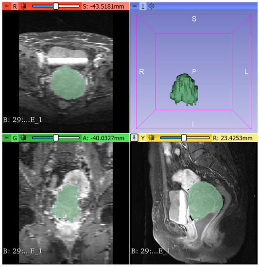 Stability and Reproducibility of Radiomic Features Based on Various ...