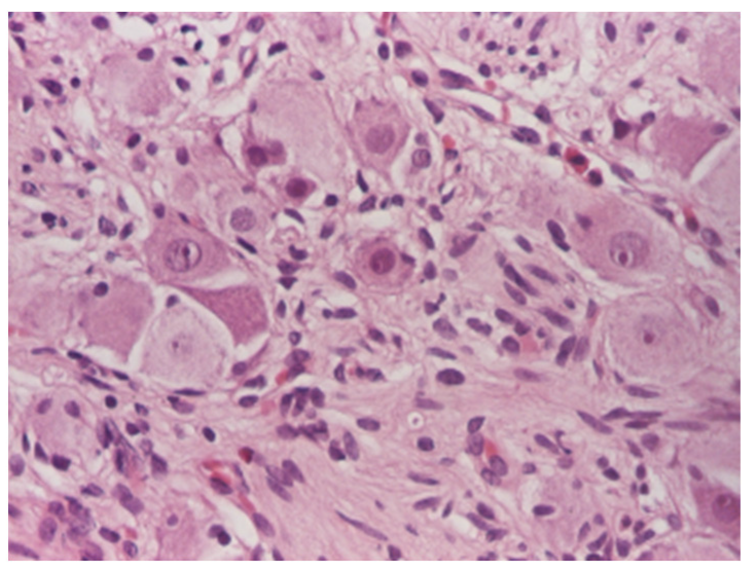 Ganglioneuroma of the Bladder in Association with Neurofibromatosis Type 1