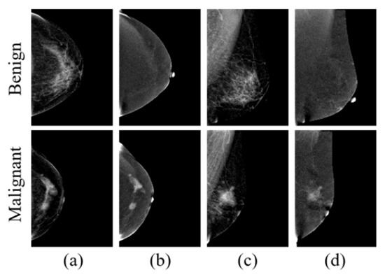 Contextual Features and Information Bottleneck-Based Multi-Input Network for Breast Cancer ...