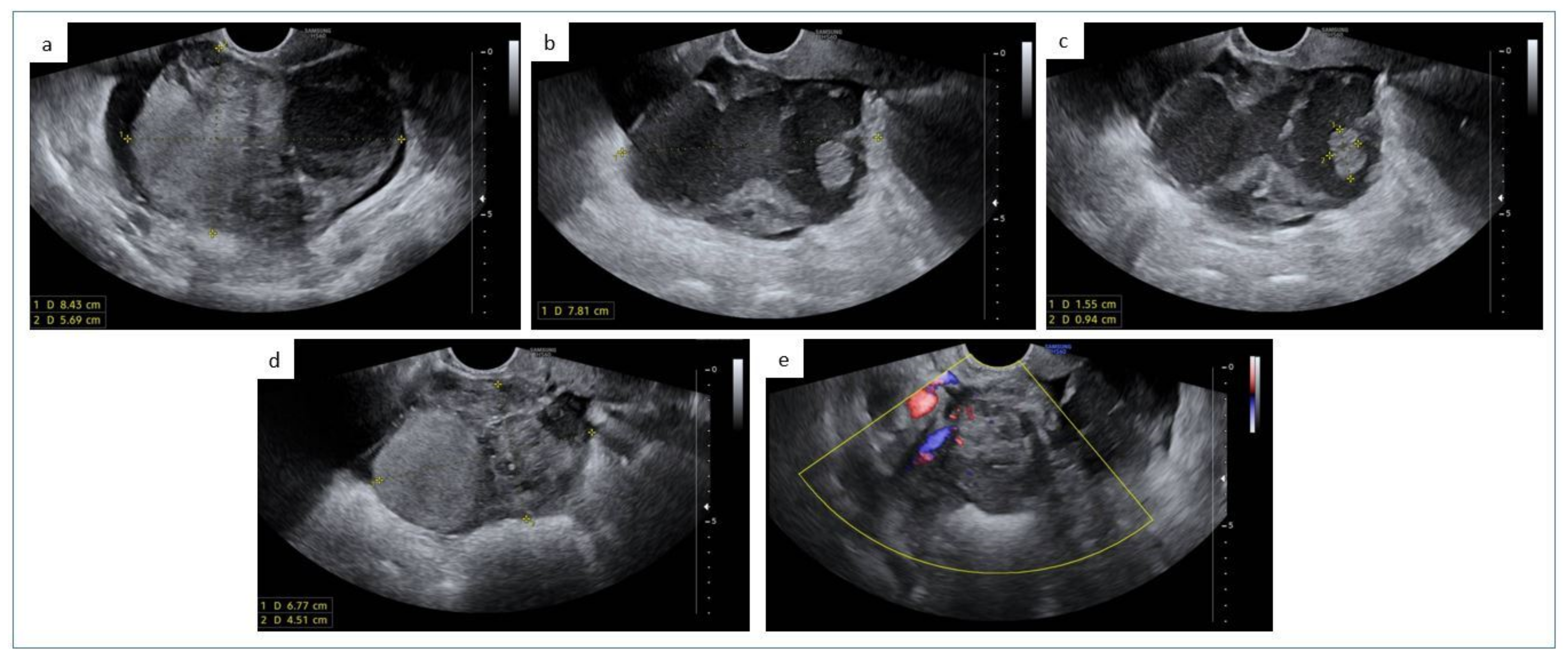 Pilomatrix-like High-Grade Endometrioid Carcinoma of the Ovary: Case ...