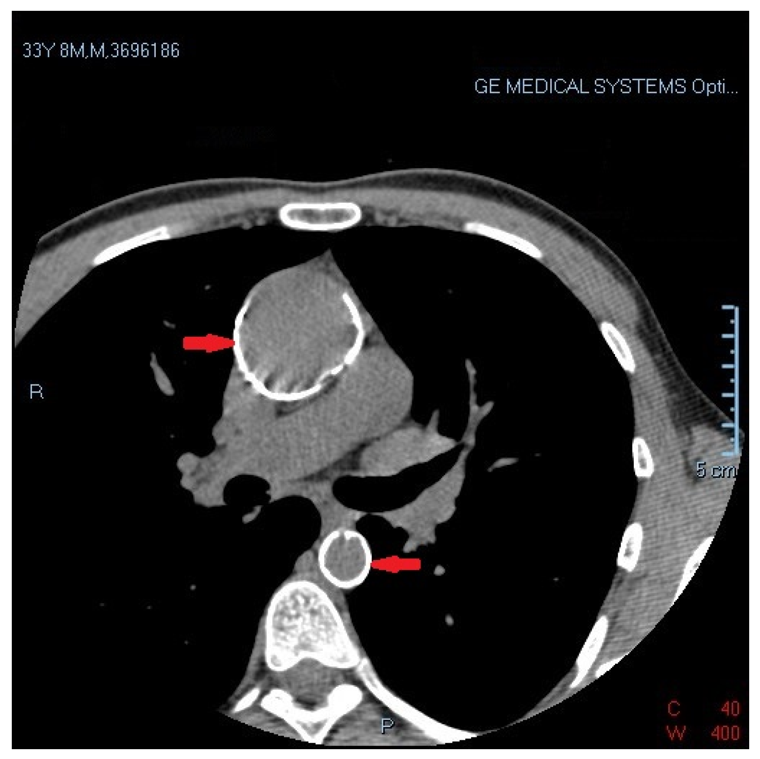 Porcelain Aorta in a Young Person Living with HIV Who Presented with Angina