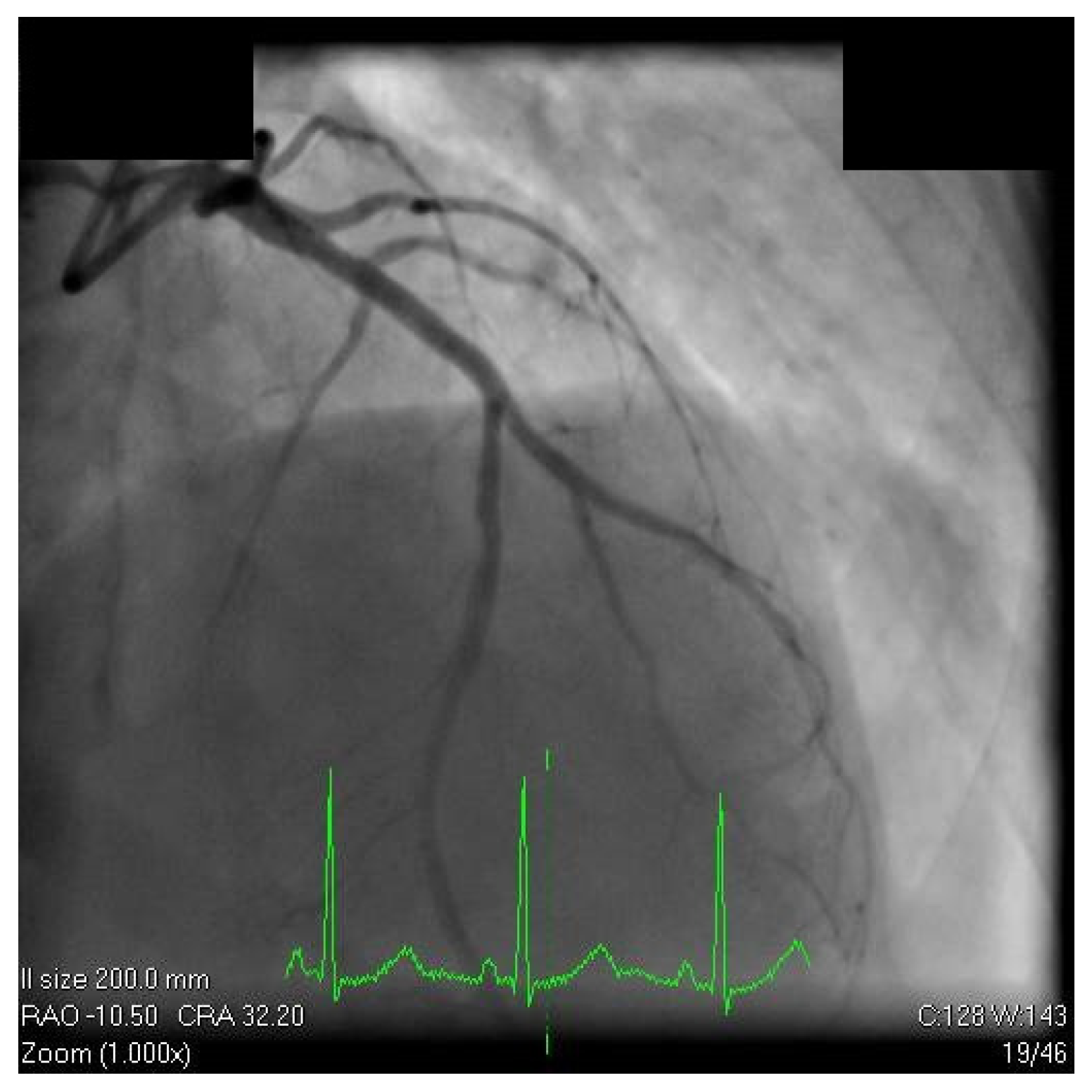 Porcelain Aorta in a Young Person Living with HIV Who Presented with Angina