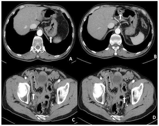 Multiple Synchronous Mucosa-Associated Lymphoid Lymphomas Involving in ...