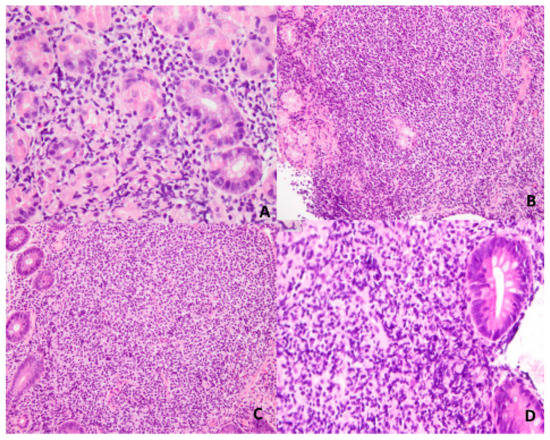 Multiple Synchronous Mucosa-Associated Lymphoid Lymphomas Involving in ...
