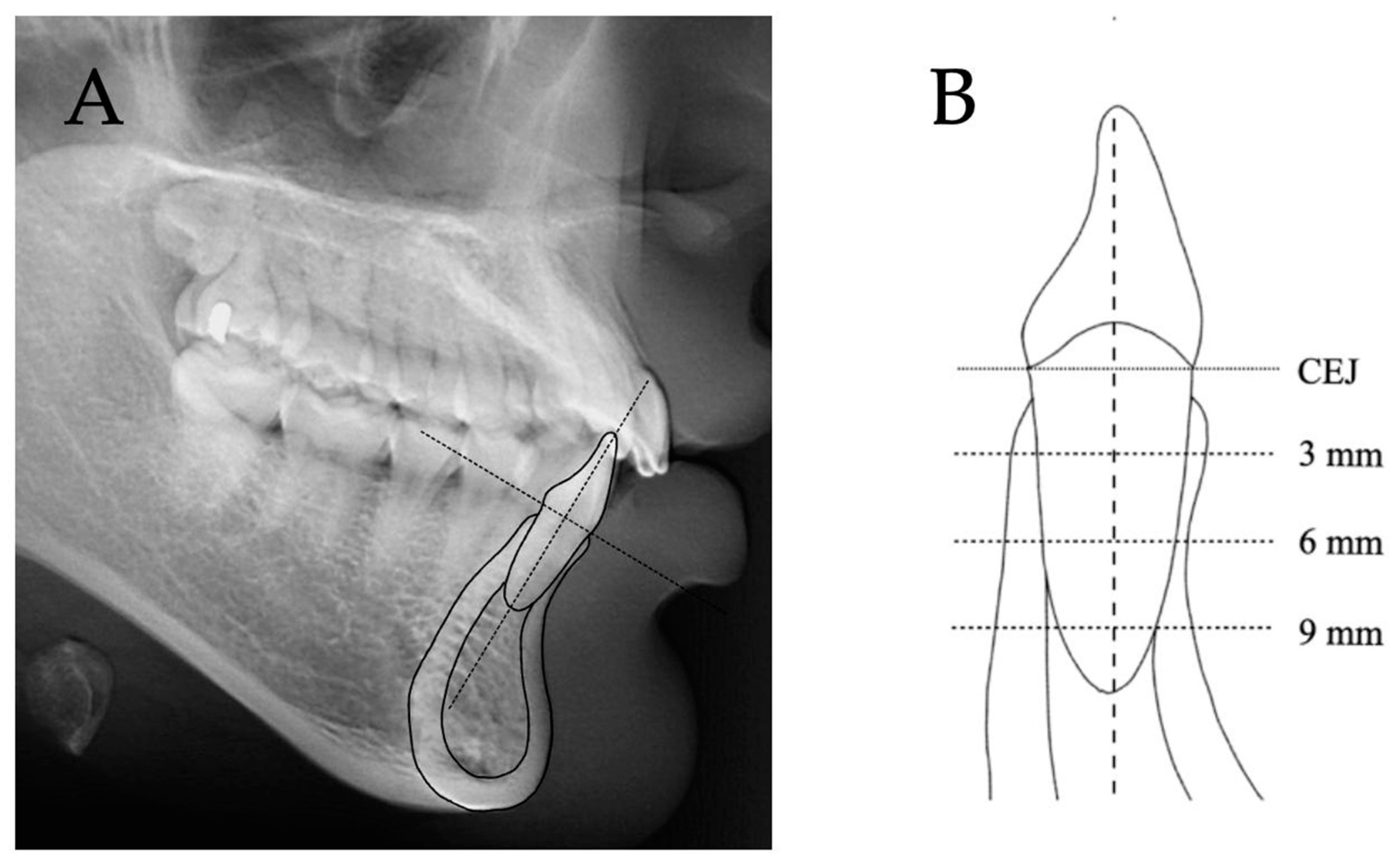 Diagnostics Vol 12 Pages 3159 The Accuracy Of Lateral Cephalogram For Measuring Alveolar
