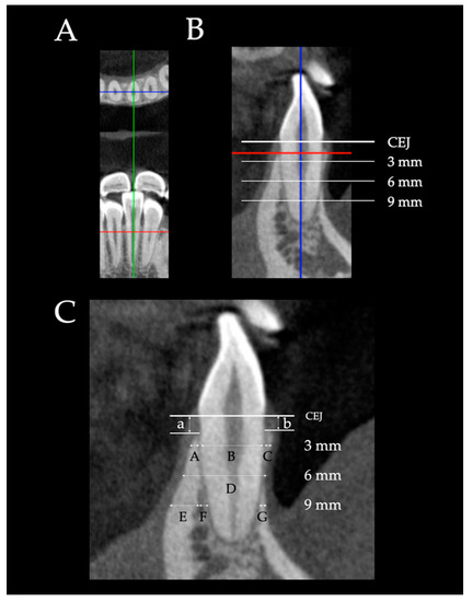 The Accuracy of Lateral Cephalogram for Measuring Alveolar Bone ...