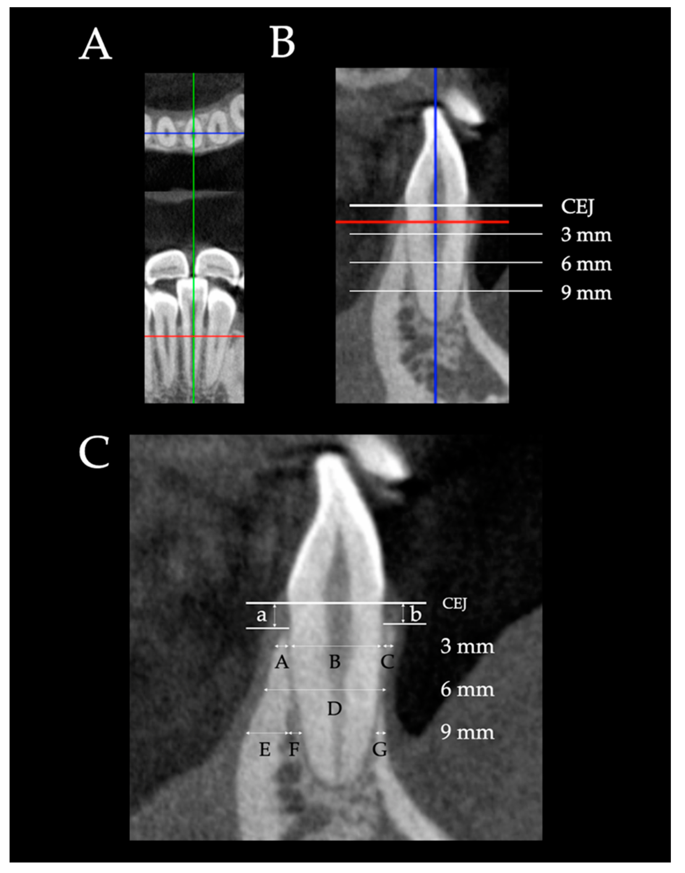 The Accuracy of Lateral Cephalogram for Measuring Alveolar Bone ...