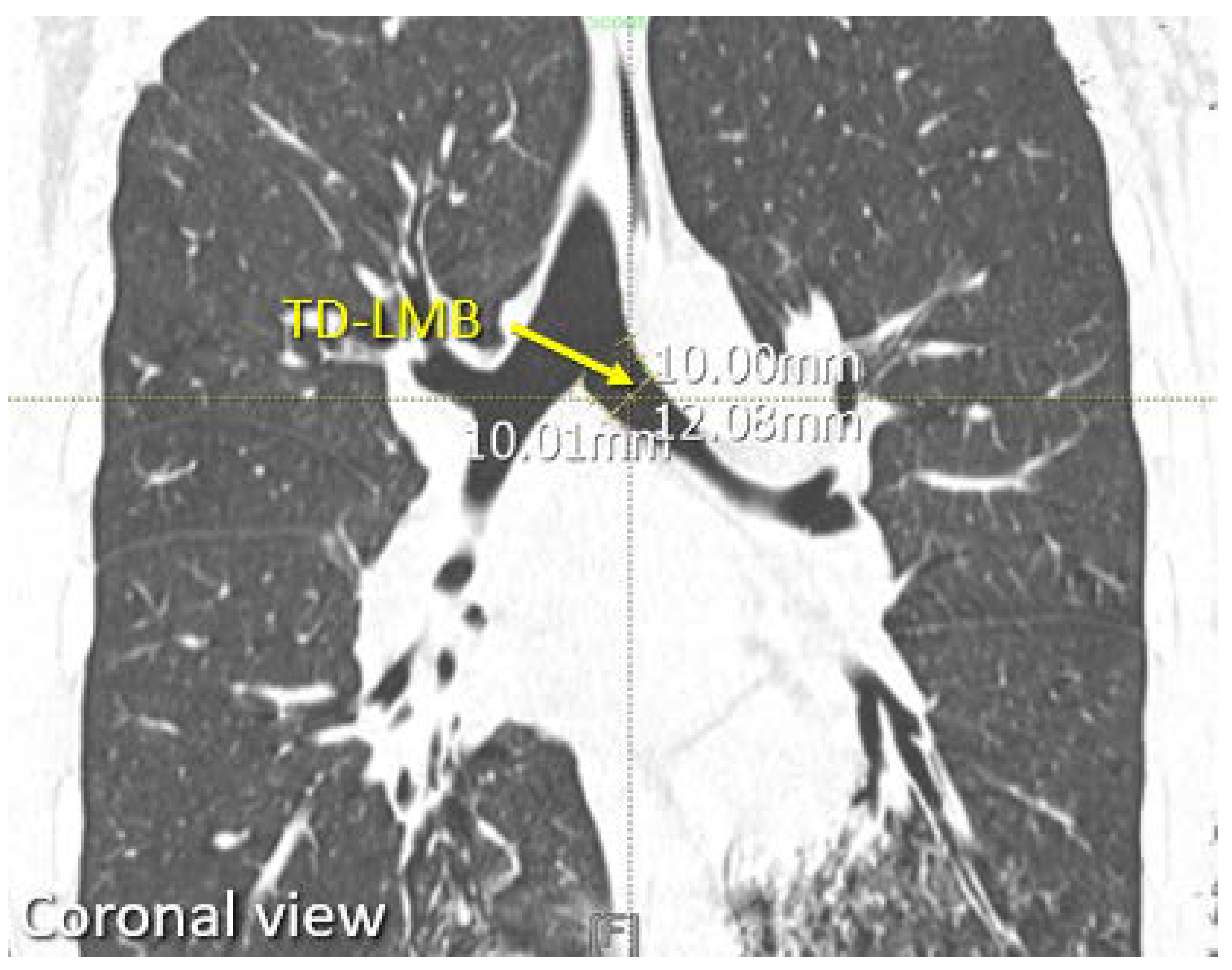 Double-Lumen Endotracheal Tube—Predicting Insertion Depth and Tube Size ...