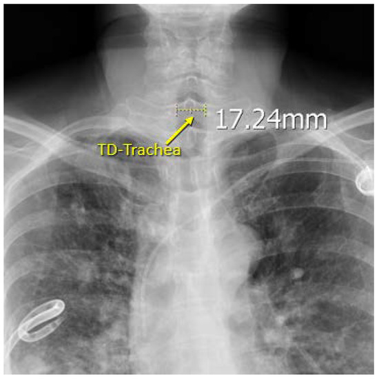 Double-Lumen Endotracheal Tube—Predicting Insertion Depth and Tube Size ...