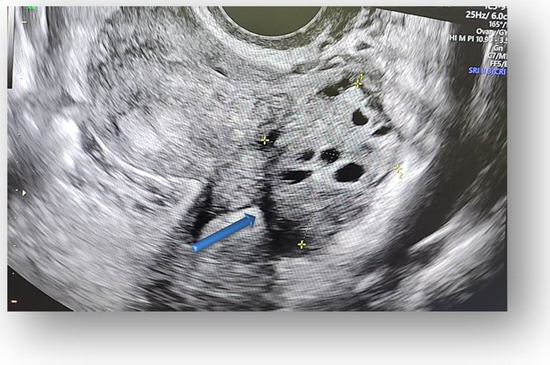 An Unusual Case of Urachal Cyst Misdiagnosed as a Paraovarian Cyst ...