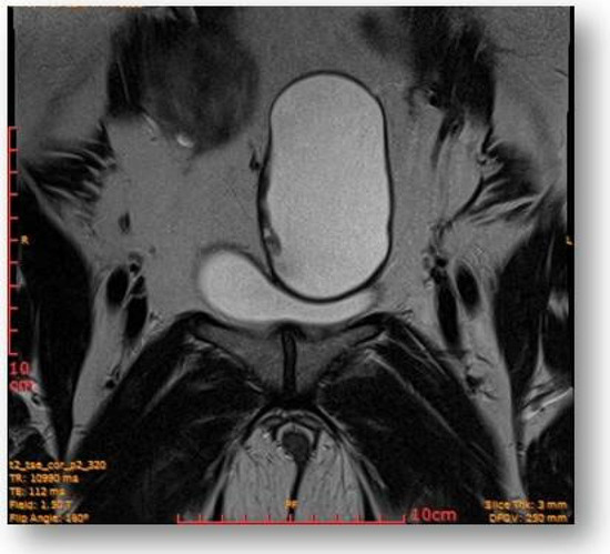 Diagnostics Free Full Text An Unusual Case Of Urachal Cyst Misdiagnosed As A Paraovarian