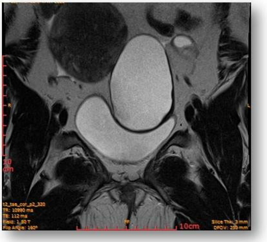An Unusual Case of Urachal Cyst Misdiagnosed as a Paraovarian Cyst ...