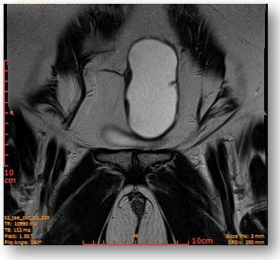Diagnostics Free Full Text An Unusual Case Of Urachal Cyst Misdiagnosed As A Paraovarian