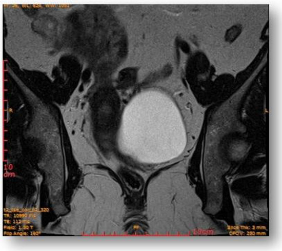 Diagnostics Free Full Text An Unusual Case Of Urachal Cyst