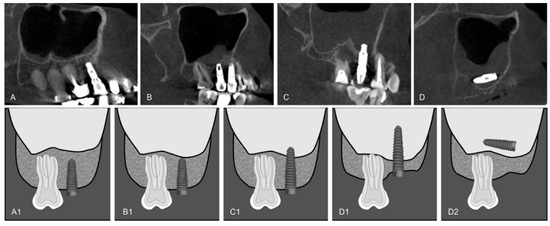 Evaluation of the Maxillary Sinus of Patients with Maxillary Posterior Implants: A CBCT Cross ...