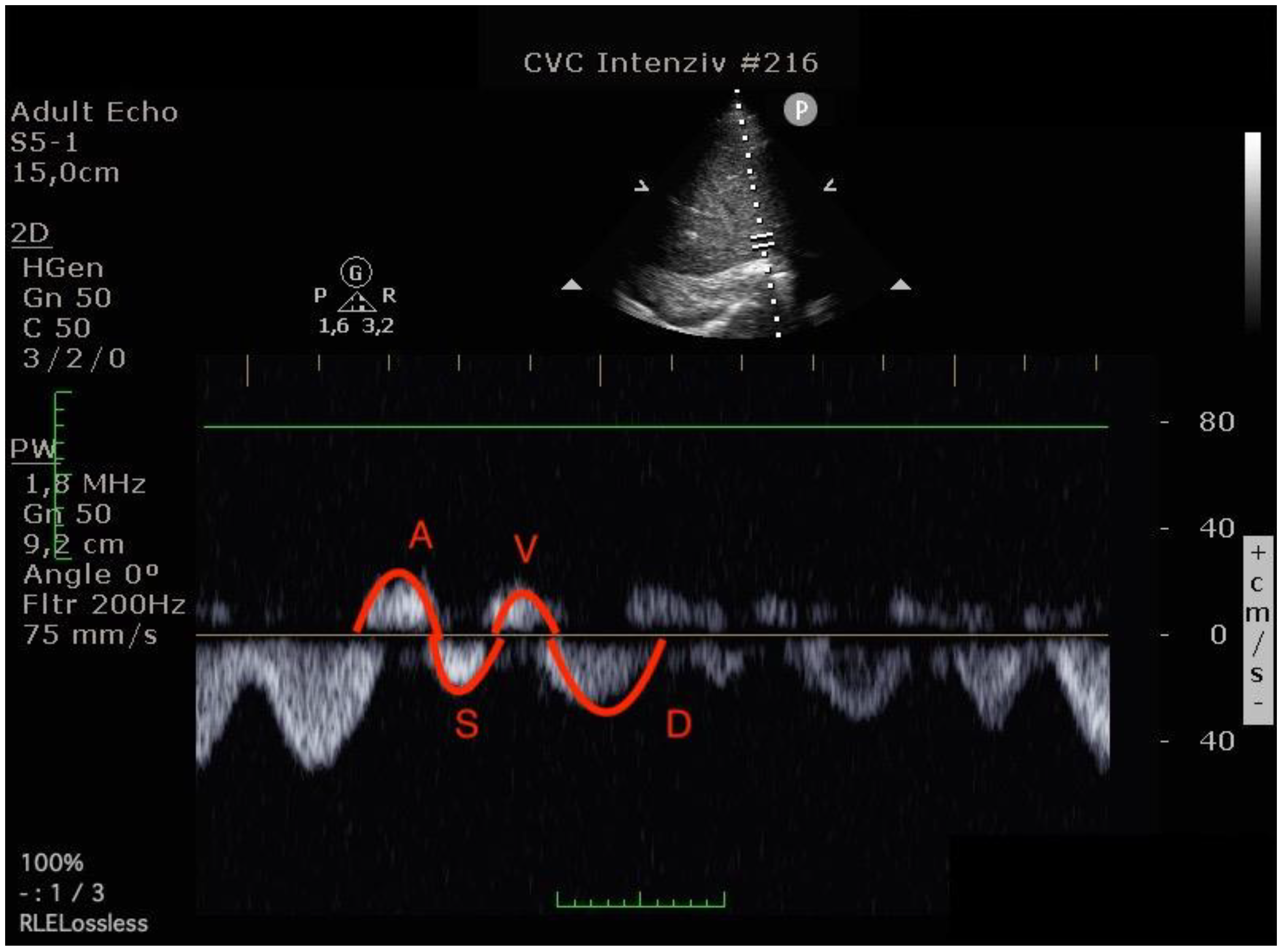 Association between Hepatic Venous Congestion and Adverse Outcomes ...