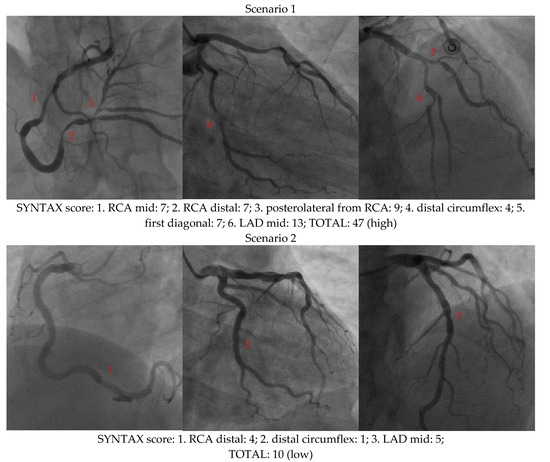 Quantitative Prediction of SYNTAX Score for Cardiovascular Artery ...