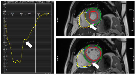 Right Ventricular Strain by Magnetic Resonance Feature Tracking Is ...