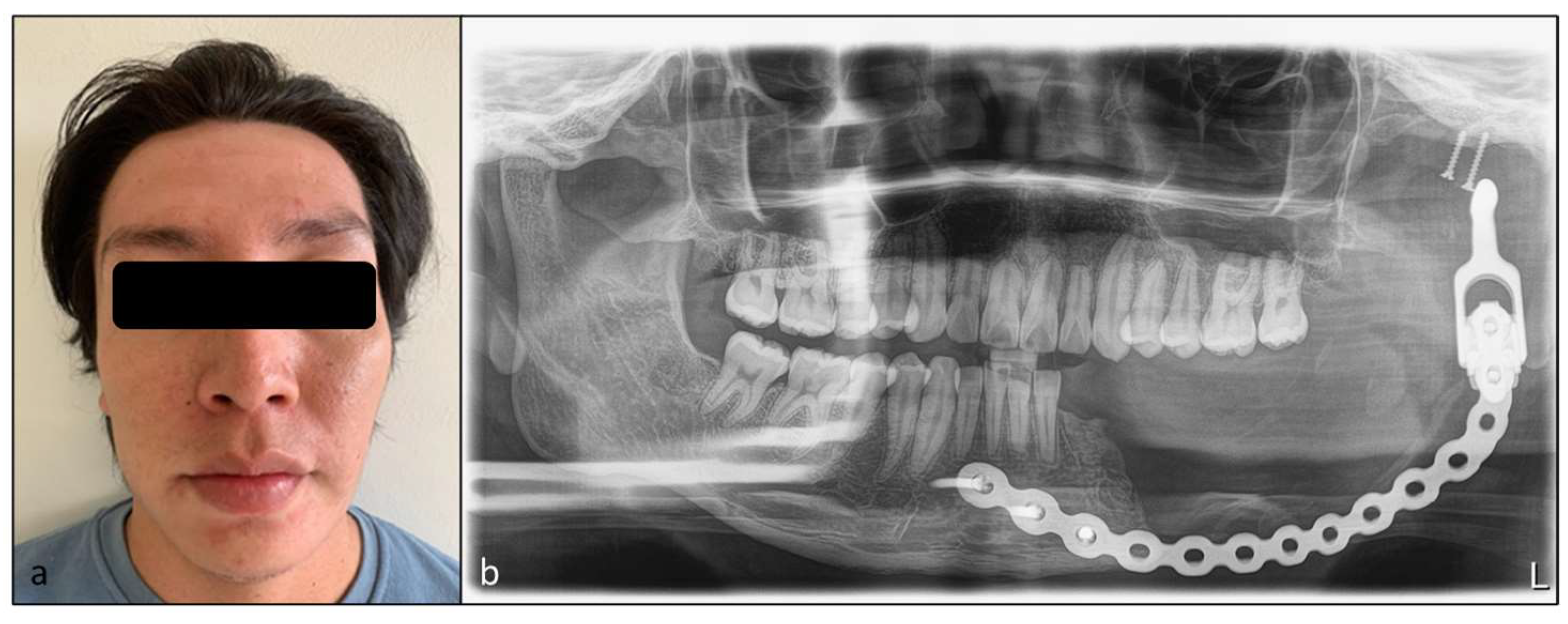 Conventional Ameloblastoma. A Case Report with Microarray and ...