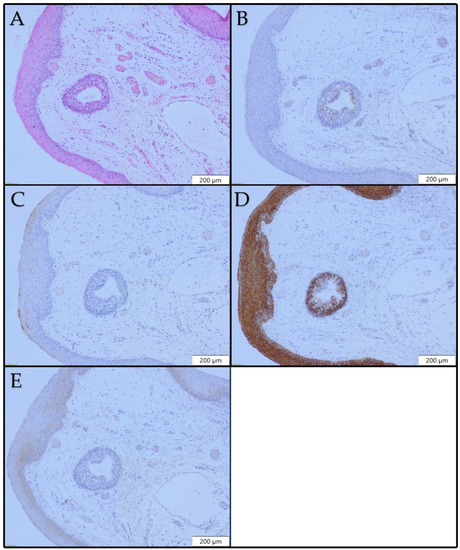 Utility of CK8, CK10, CK13, and CK17 in Differential Diagnostics of ...