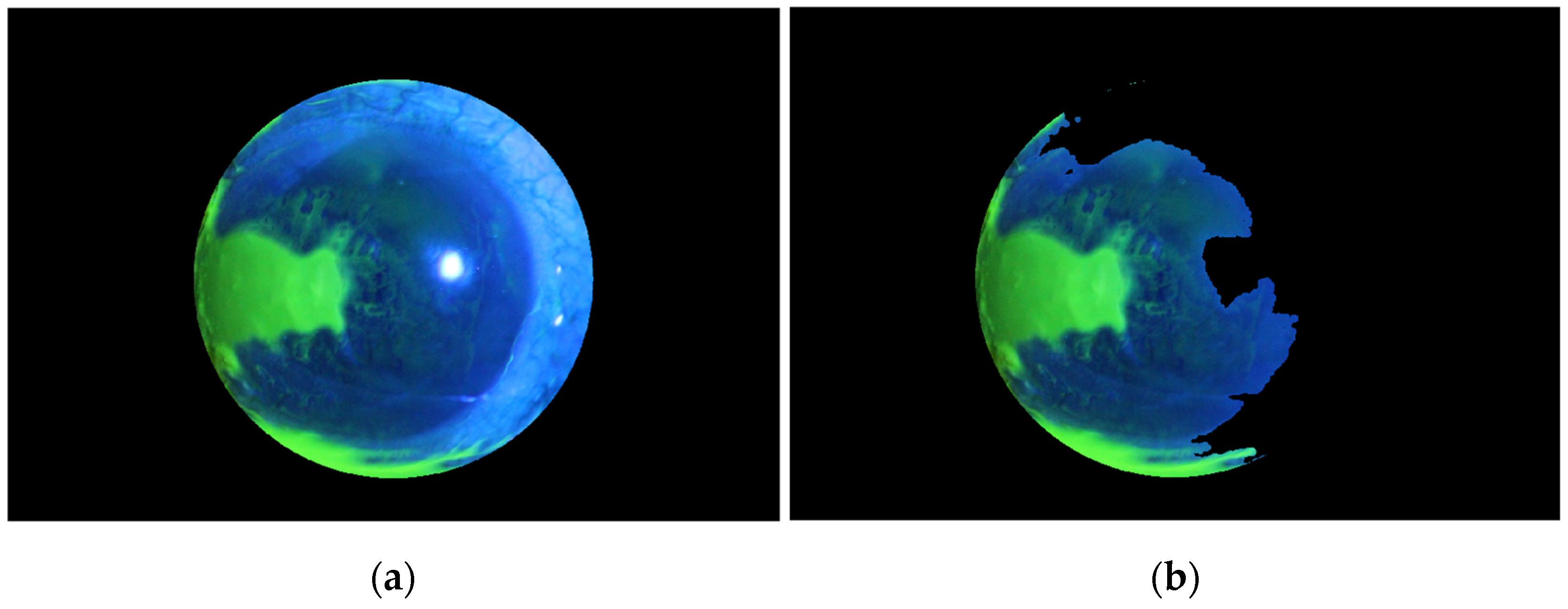 Automated Detection of Corneal Ulcer Using Combination Image Processing and Deep Learning