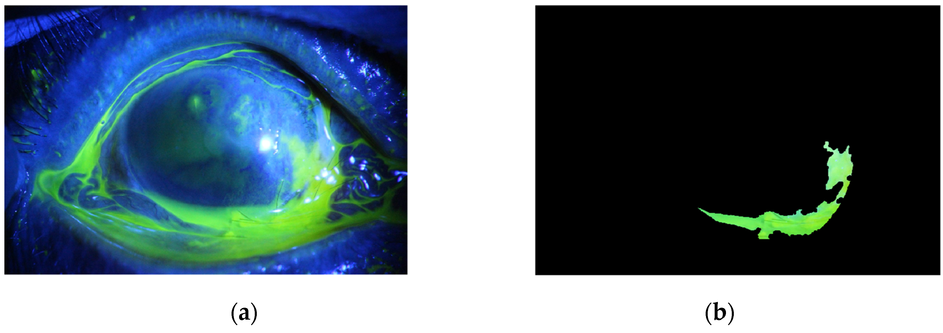 Automated Detection of Corneal Ulcer Using Combination Image Processing and Deep Learning