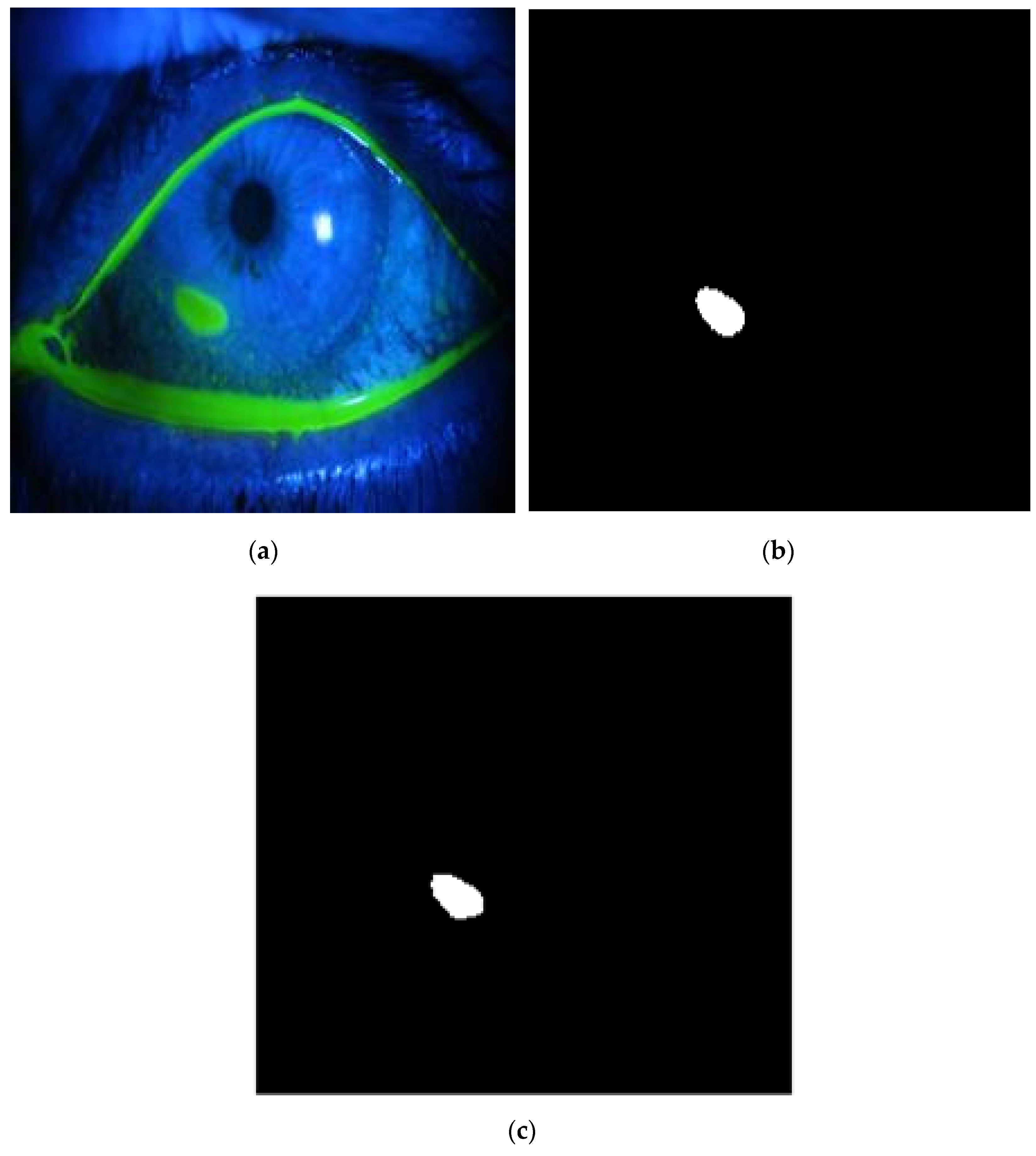 Automated Detection of Corneal Ulcer Using Combination Image Processing and Deep Learning