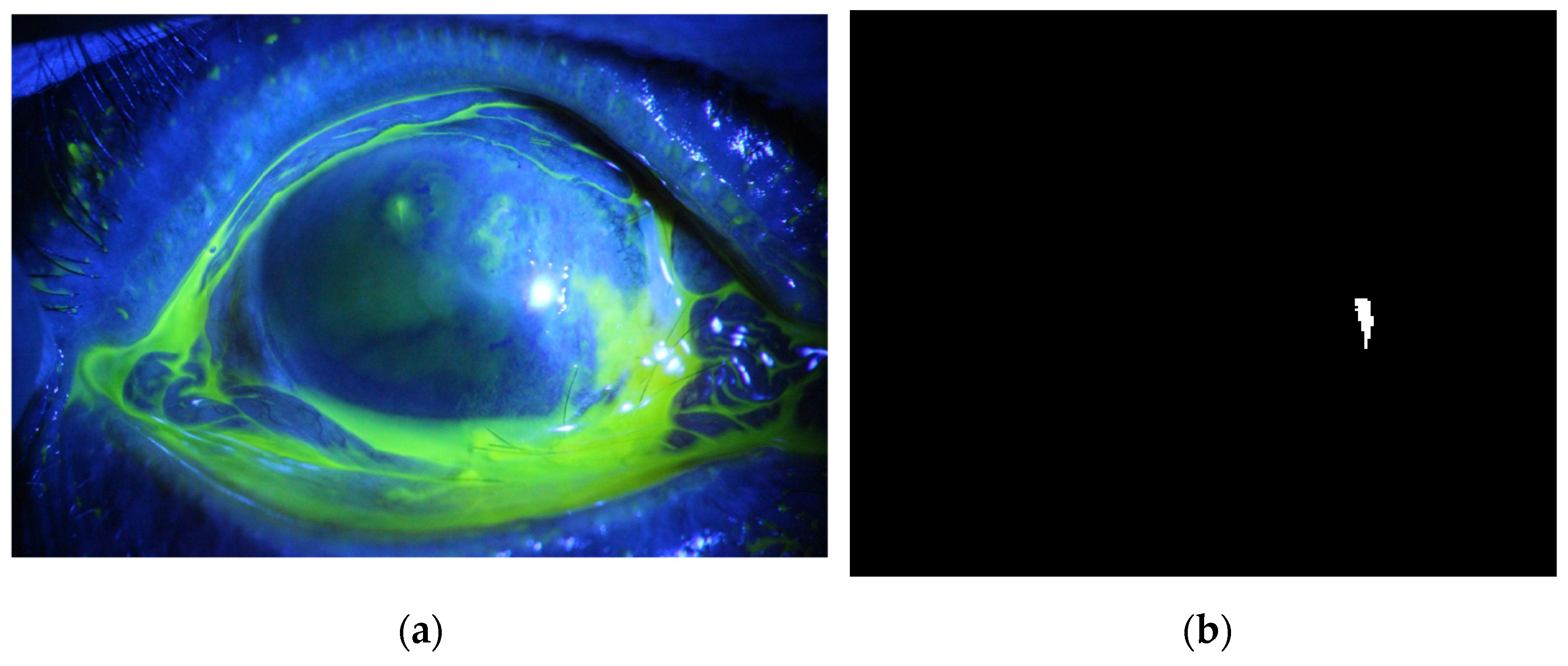 Automated Detection of Corneal Ulcer Using Combination Image Processing and Deep Learning
