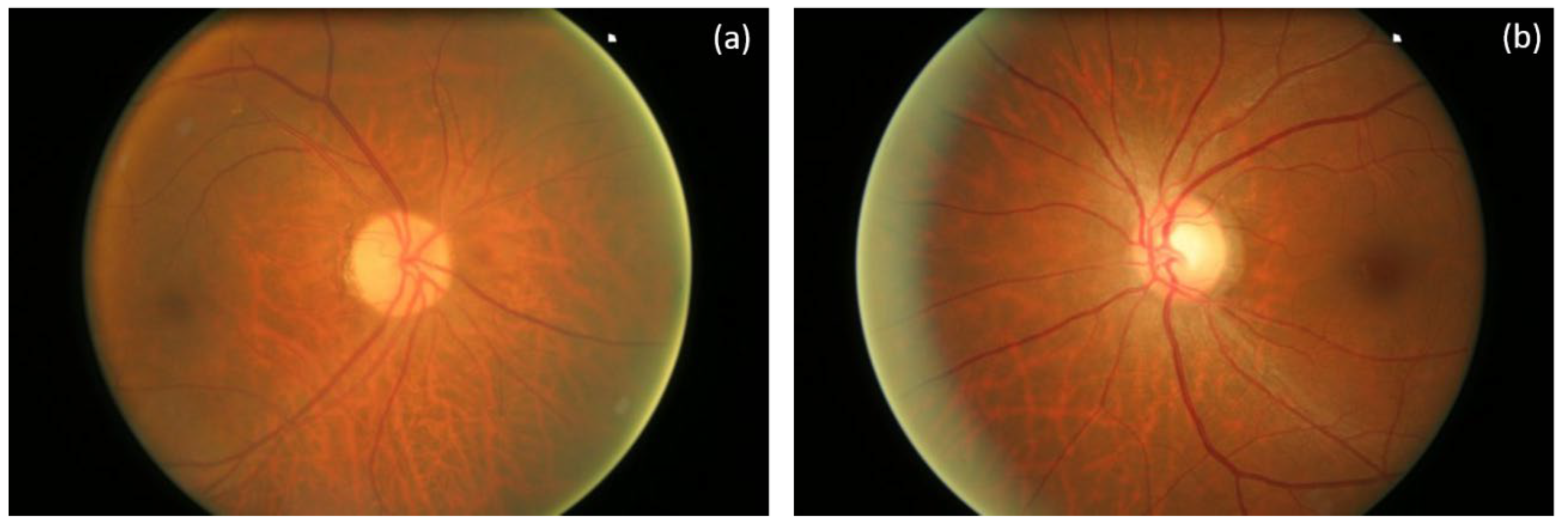 Superpixel-Based Optic Nerve Head Segmentation Method of Fundus Images ...