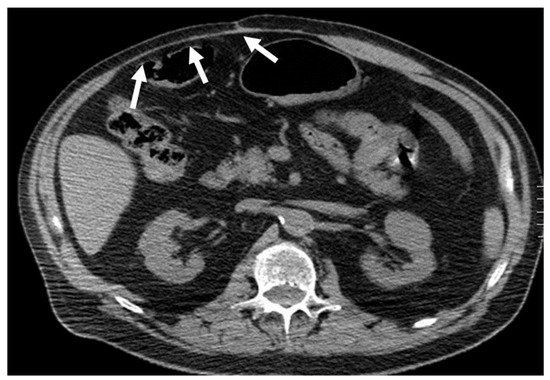 The Benign Side of the Abdominal Wall: A Pictorial Review of Non ...