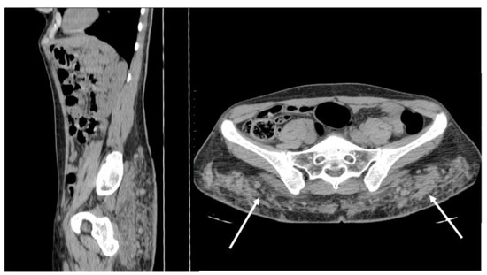 The Benign Side of the Abdominal Wall: A Pictorial Review of Non ...