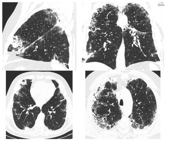 Pulmonary Fibrosis Related to Amiodarone—Is It a Standard ...