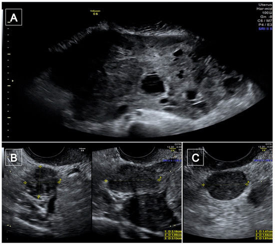 An Extremely Rare Case of Disseminated Peritoneal Leiomyomatosis with a ...