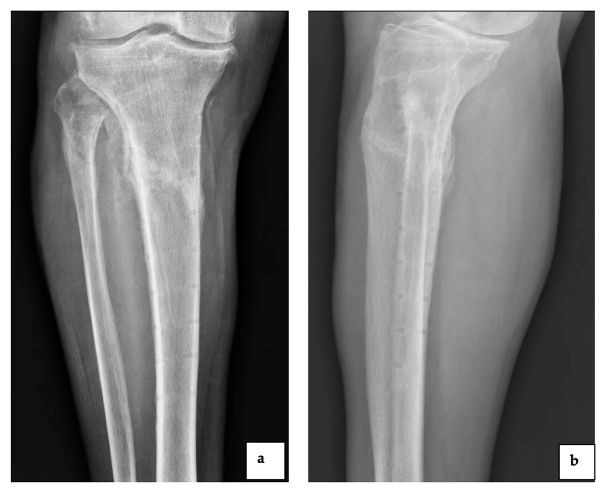 Orthopedic Device-Related Infections Due to Emerging Pathogens ...