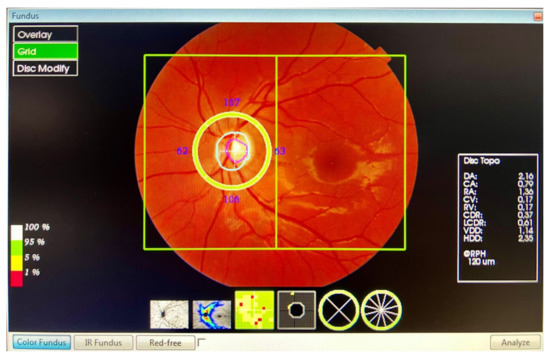 Decrease Retinal Thickness in Patients with Chronic Migraine Evaluated ...