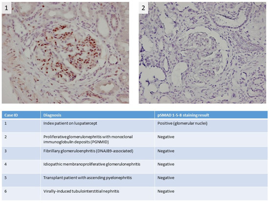 Immune Complex Glomerulonephritis in a Patient with Myelodysplastic ...