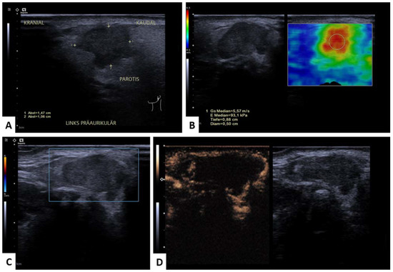 Assessment of Parotid Gland Tumors by Means of Quantitative ...