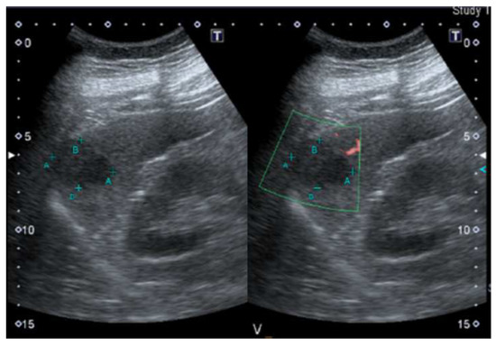 Unusual Rapid Growth of Primary Splenic Diffuse Large B-Cell Lymphoma ...