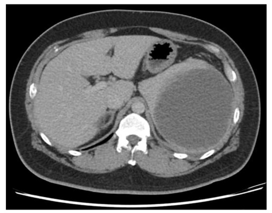 Unusual Rapid Growth of Primary Splenic Diffuse Large B-Cell Lymphoma ...