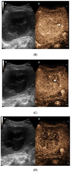 Ultrasound-Guided Coarse Needle Biopsy Diagnosed Isolated Hepatic ...