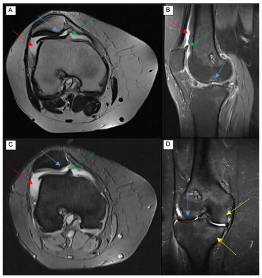 Advanced MR Imaging for Knee Osteoarthritis: A Review on Local and ...