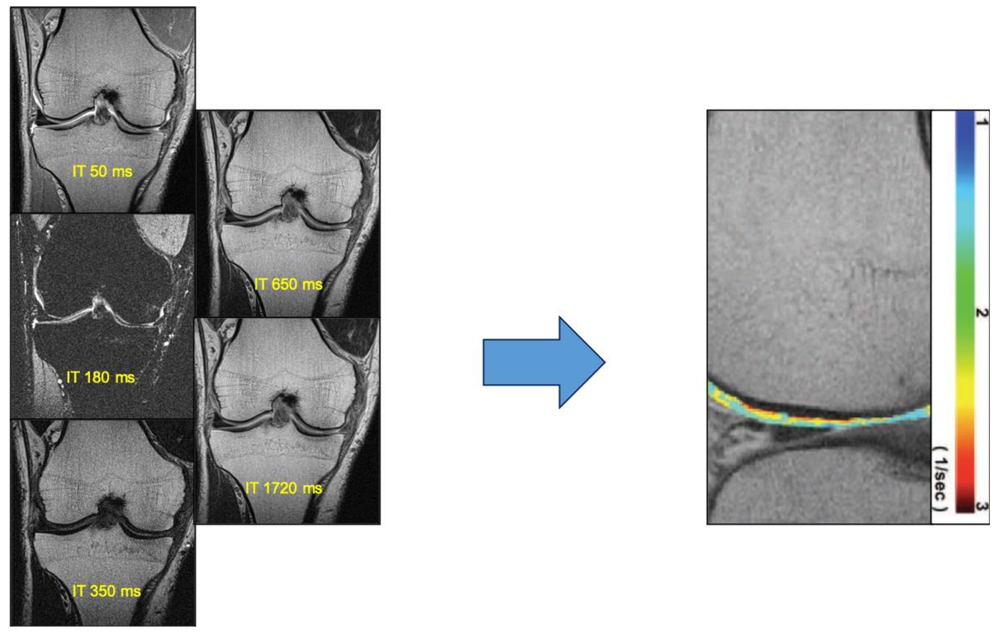 Advanced MR Imaging for Knee Osteoarthritis: A Review on Local and Brain Effects