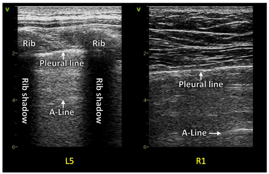 One-Year Follow-Up Lung Ultrasound of Post-COVID Syndrome—A Pilot Study