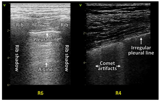 One-Year Follow-Up Lung Ultrasound of Post-COVID Syndrome—A Pilot Study