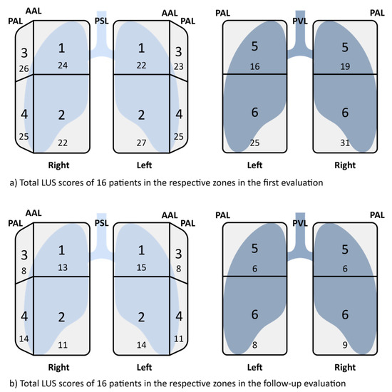 One-Year Follow-Up Lung Ultrasound of Post-COVID Syndrome—A Pilot Study